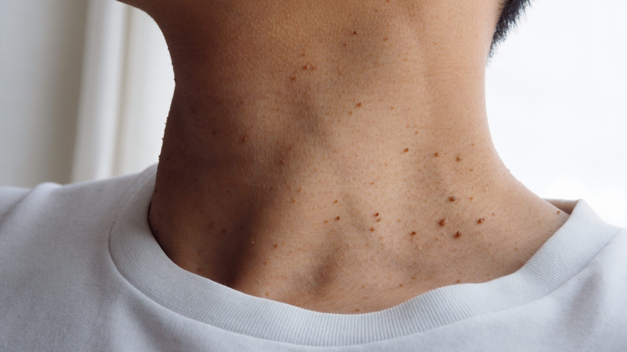 How Long Does Mole Removal Take? Step-by-Step Guide